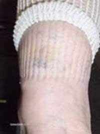 Edema wear Open-Toe Medium Single-34 inch Long Stockinets Fits foot to ...