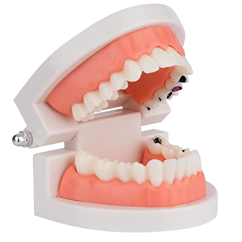 Mua ANNWAH Tooth Decay Model - Dental Decay Model Caries Teaching Tool ...