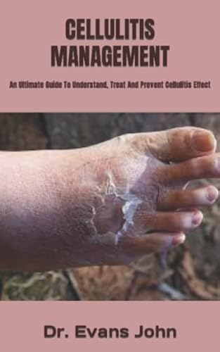 CELLULITIS MANAGEMENT: An Ultimate Guide To Understand, Treat And ...