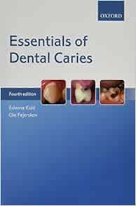 Essentials of Dental Caries: 9780198738268: Medicine & Health Science ...