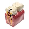 Dental Caries Tooth Model, YOUYA DENTAL Decay Teeth Comparative Study ...