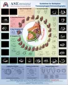 Performing a Comprehensive Intraoperative Multiplane TEE Exam Poster (ASE Guidelines Posters ...