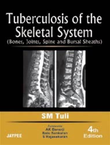 Tuberculosis of the Skeletal System: Bones, Joints, Spine and Bursal ...