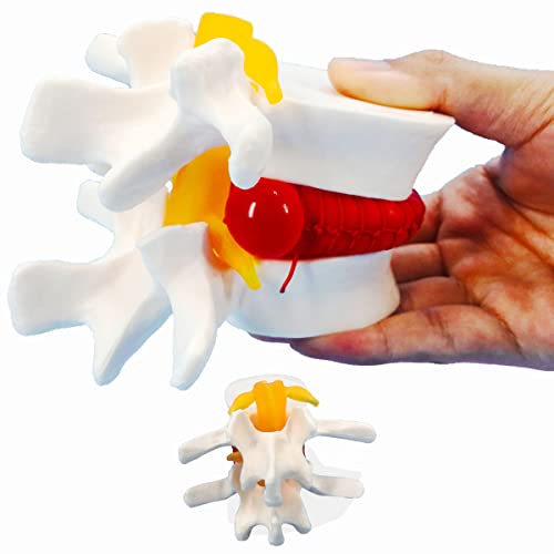 Veipho Human Anatomical Lumbar Disc Herniation Model, Movable Human ...