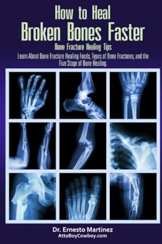 How to Heal Broken Bones Faster. Bone Fracture Healing Tips: Learn ...