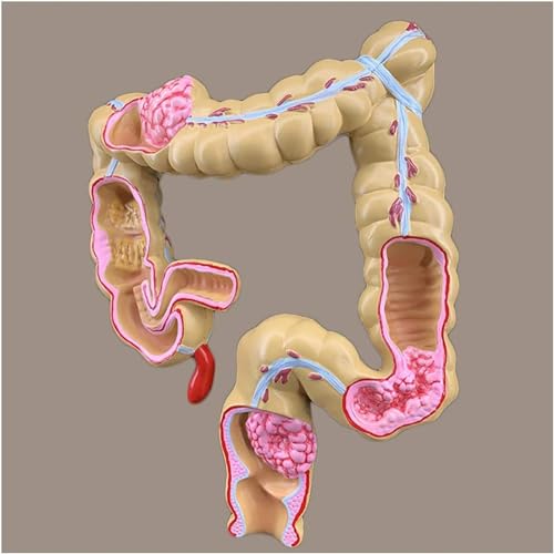 FKTHYO Colorectal Pathology Model, Gastrointestinal Model, Colorectal ...