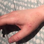 Dermfix 1000MX UV-B Lamp for Psoriasis, Vitiligo or Eczema: Amazon.ca ...