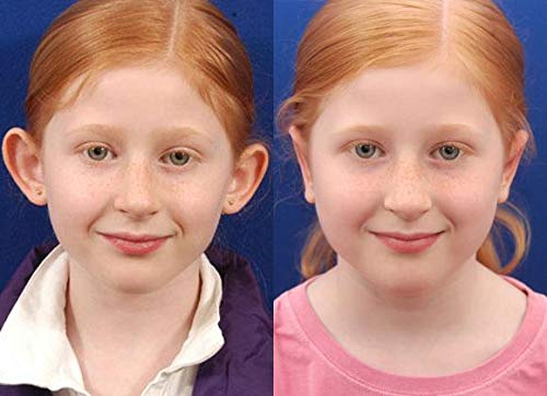 Ear Fold Clips Before Surgery Big Ear Corrector Cuff Protruding Auricle ...