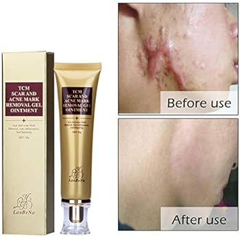 Amazon.com : BEST Scar Removal Cream Treatment: Advanced New & Old ...