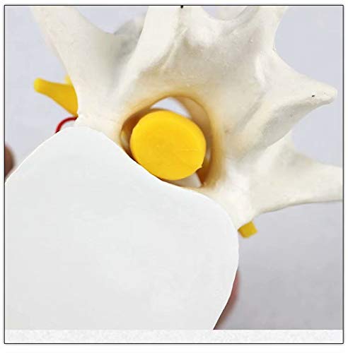 Human Lumbar Disc Protrusion Demonstration Model Lumbar Intervertebral ...