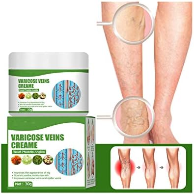 Supwell Varicose Veins Relief Cream, Spider Leg Repair Cream, Spider ...