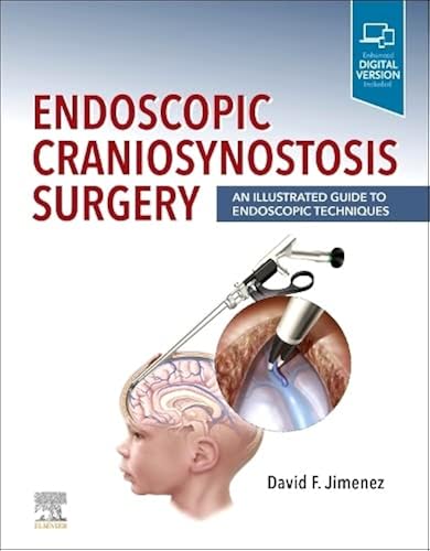 Endoscopic Craniosynostosis Surgery: An Illustrated Guide to Endoscopic ...