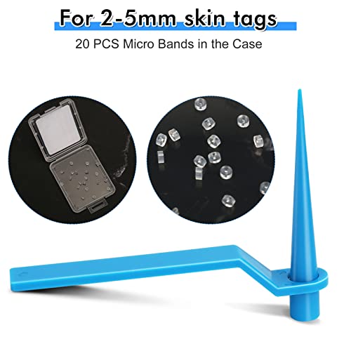 Micro Skin Tag Remover Kit - Painless Skin Tag Removal Tag Away Skin ...