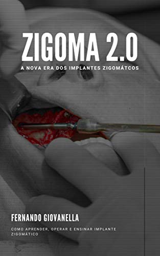 ZIGOMA 2.0 - A Nova Era dos Implantes Zigomáticos: Como aprender ...