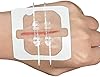 Zip Stitch Sutures 2.8 x 2.36 inches, zipstitch Laceration Closures kit ...
