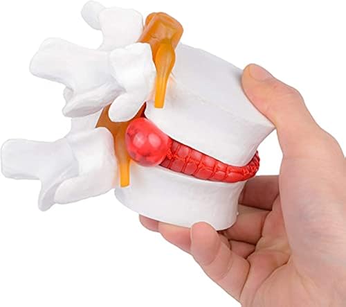 MIIRR Human Lumbar Disc Herniation Model, Vertebral Spine Anatomical ...