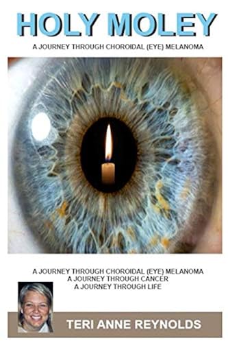 Holy Moley: A Journey Through Choroidal (Eye) Melanoma in Kuwait ...