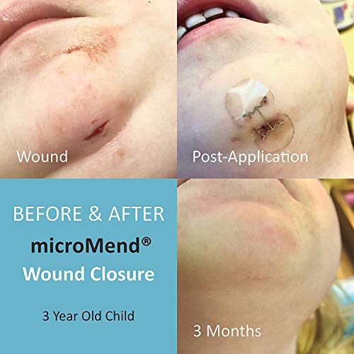 microMend Emergency Wound Closures Surgical Quality Laceration Repair ...