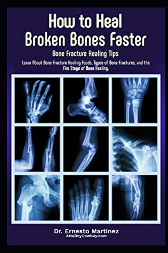 How to Heal Broken Bones Faster. Bone Fracture Healing Tips: Learn ...