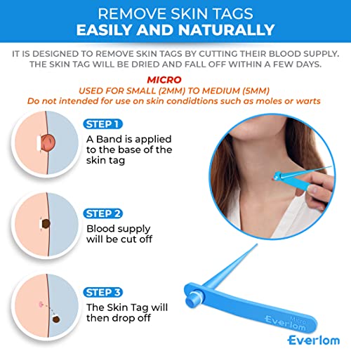Micro Skin Tag Remover- Fast and Easy Skin Tag Remover- Painless Skin ...