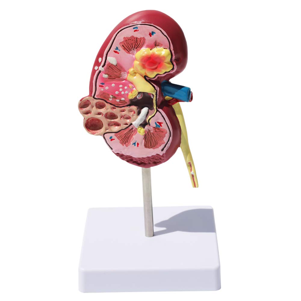 Buy LIUU Human Kidney Model-Kidney Model-Anatomical Anatomy-Human ...