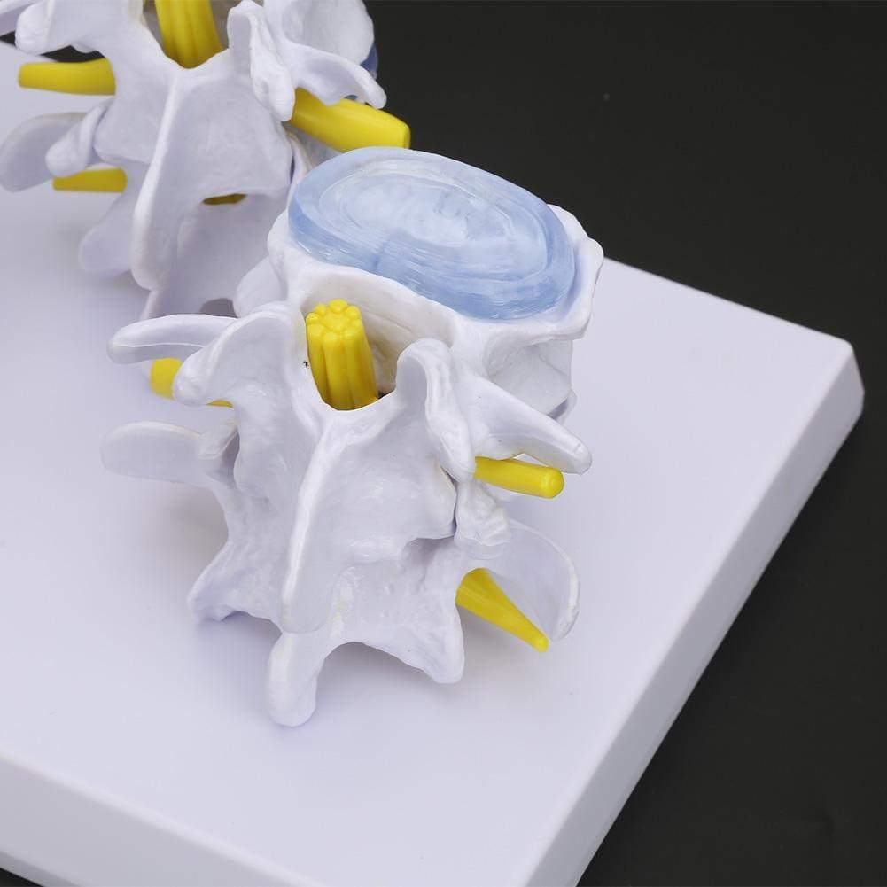 Hililand 4 Steps Anatomical Vertebrae Model Combination of Human Lumbar ...