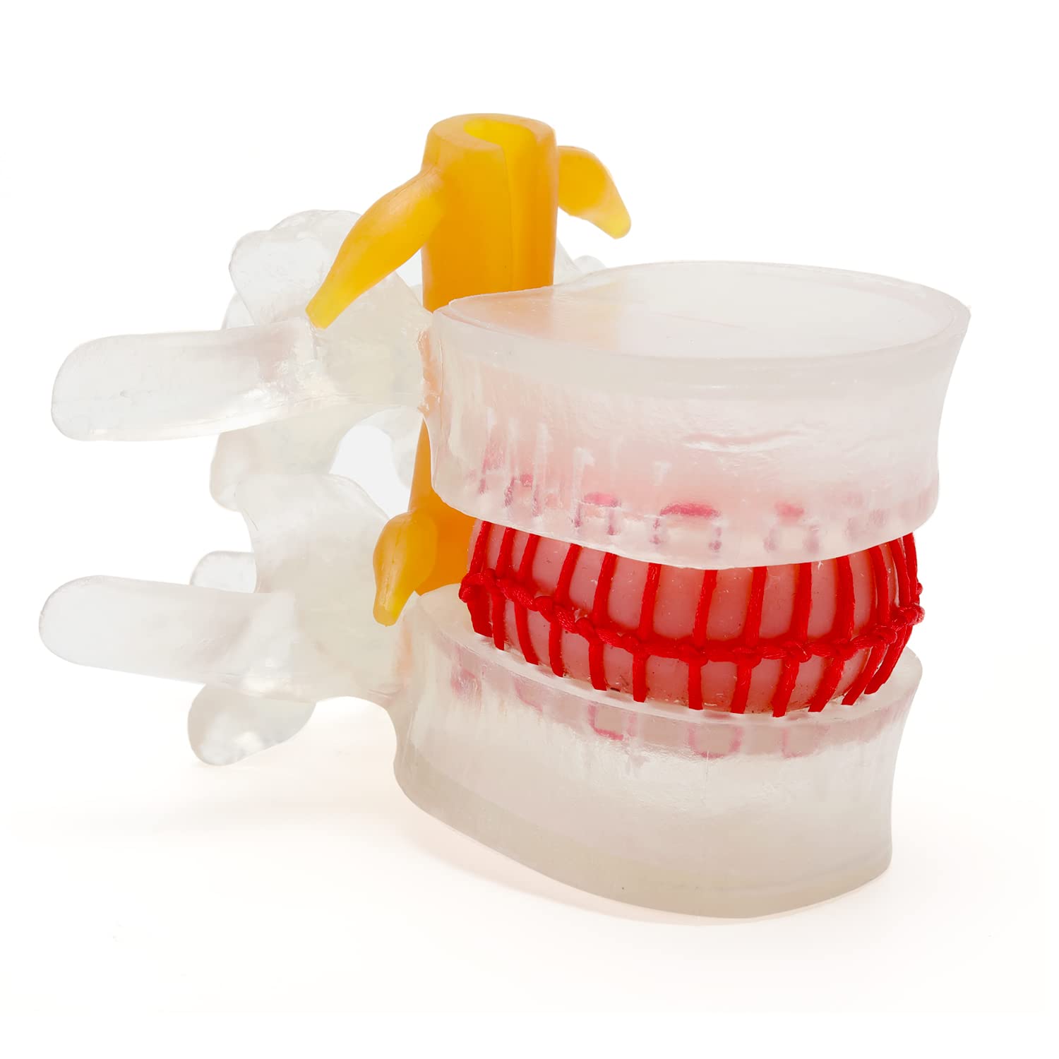 Mua RONTEN Human Lumbar Disc Herniation Model, Transparent Lumbar Spine ...