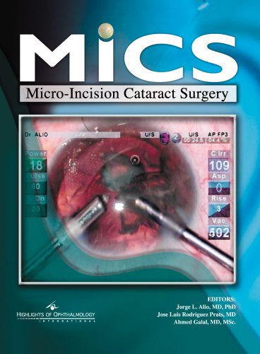 MICS Micro-Incision Cataract Surgery with CD-ROM: Alio: 9789962613305 ...