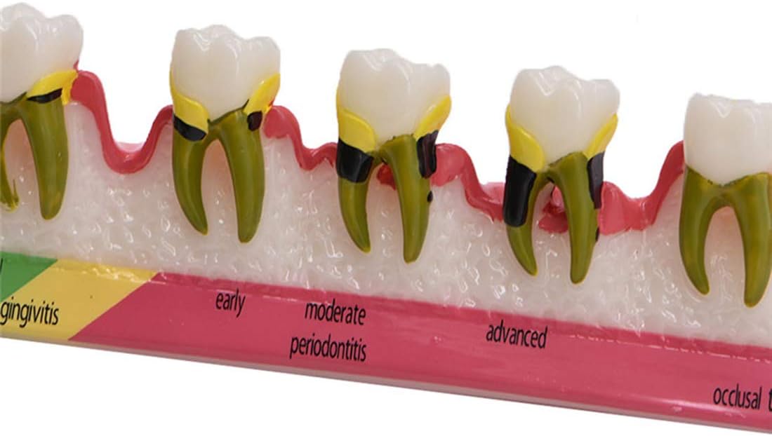 Dental Teeth Model, Periodontal Disease Assort Tooth Typodont Teach ...