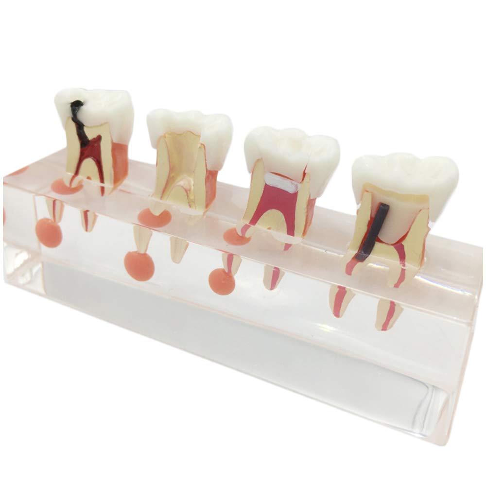 Buy YZ-YUAN Assembly Educational Model Dental Oral Cavity Pulp Disease ...