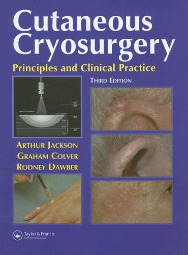 Cutaneous Cryosurgery: Principles and Clinical Practice: 9781841845524 ...