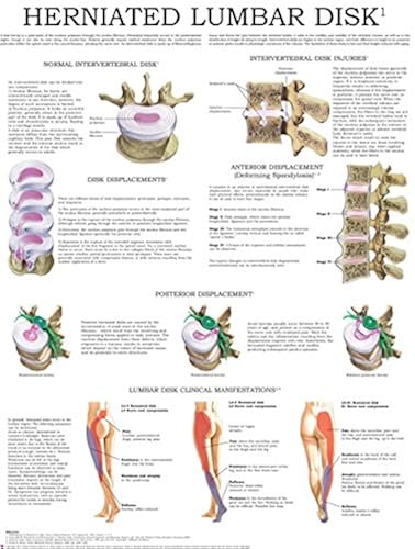 Herniated Lumbar Disk - Quick Reference Chart: Full illustrated in ...