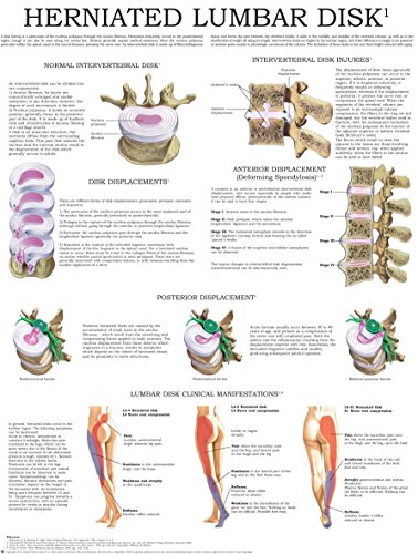 Herniated Lumbar Disk - Quick Reference Chart: Full illustrated in ...