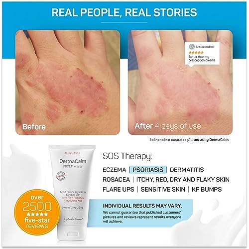 Clinically Tested DermaCalm SOS Therapy - Eczema Psoriasis Dermatitis ...