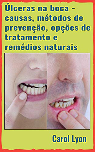 Úlceras na boca - causas, métodos de prevenção, opções de tratamento e ...