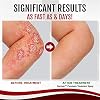 LONGLUAN Kolmax Vitiligo Relief Spray, Kolmax Psoriasis Relief Spray ...