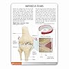 Knee Joint w/Meniscus Tear Model | Human Body Anatomy Replica of Knee ...