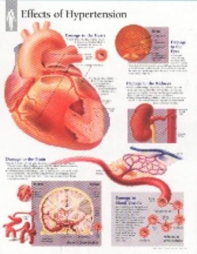 Effects of Hypertension chart: Laminated Wall Chart in Dubai - UAE ...