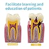 ANNWAH Dental Caries Teeth Model,Dental Anatomy Education Tooth Model,6 ...