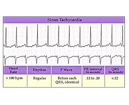 Amazon.com: 12 Lead EKG Electrocardiogram Training, EKG Basics, And ECG ...
