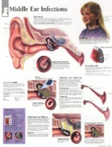 Middle Ear Infection chart: Wall Chart in Dubai - UAE | Whizz United States