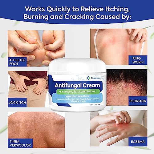 Antifungal Ringworm Cream- Treats Stubborn Ringworm- Antifungal Cream ...