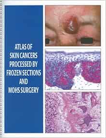 Atlas of Skin Cancers Processed by Frozen Sections and Mohs Surgery ...