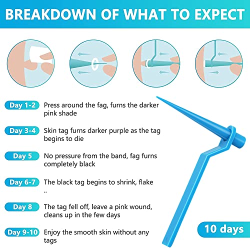 Micro Skin Tag Remover Kit - Painless Skin Tag Removal Tag Away Skin ...