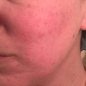 Amazon.com : Sulphur Soap - Premium 10% Sulfur Advanced Wash for Acne. Natural Fresh Scent ...