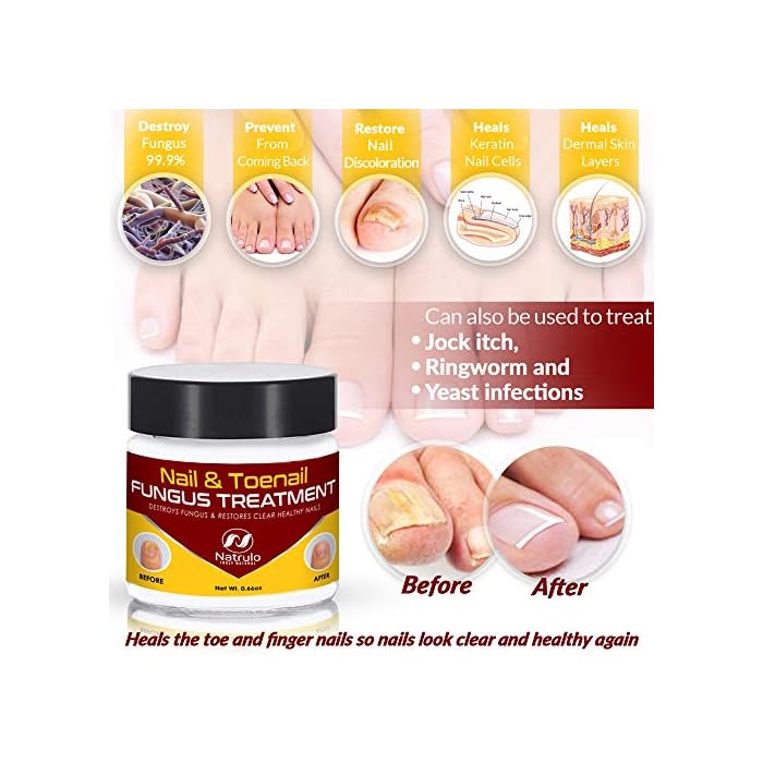 Natrulo Nail & Toenail Treatment - Herbal Nail Cream with Tolnaftate ...