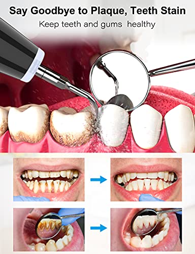 Plaque Remover For Teeth - Sonic Electric Tooth Cleaner, Tartar ...