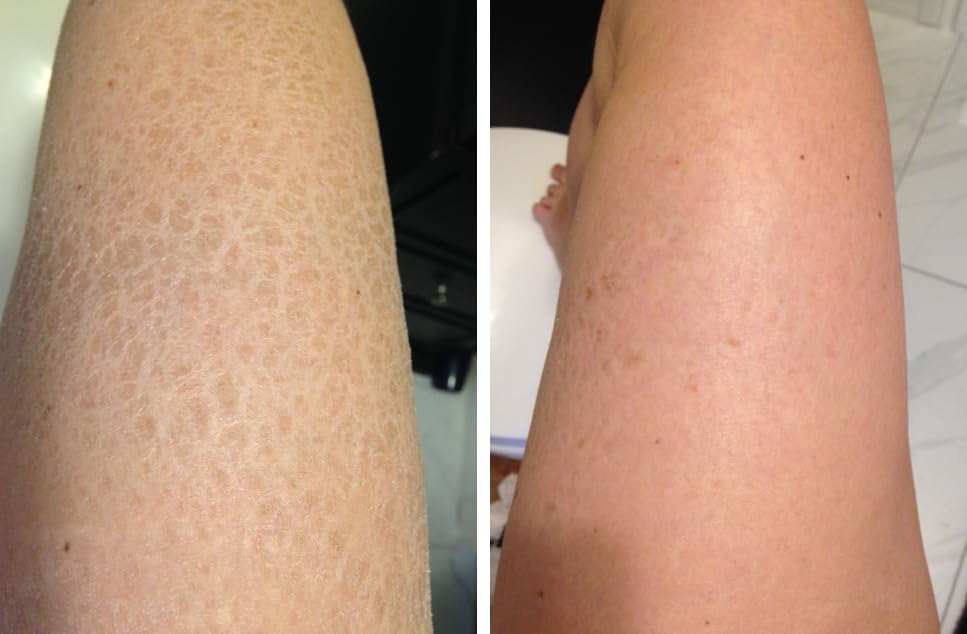 G16 Skin Repair, Very Dry Skin & Ichthyosis Treatment Cream & Lotion on ...