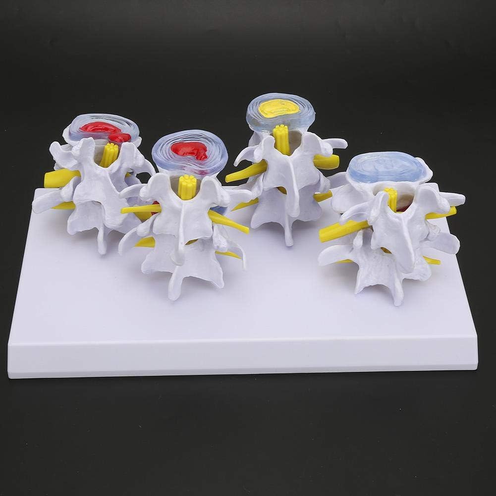 Hililand 4 Steps Anatomical Vertebrae Model Combination of Human Lumbar ...