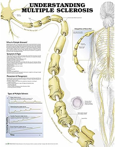 Understanding Multiple Sclerosis Anatomical Chart | Pricepulse
